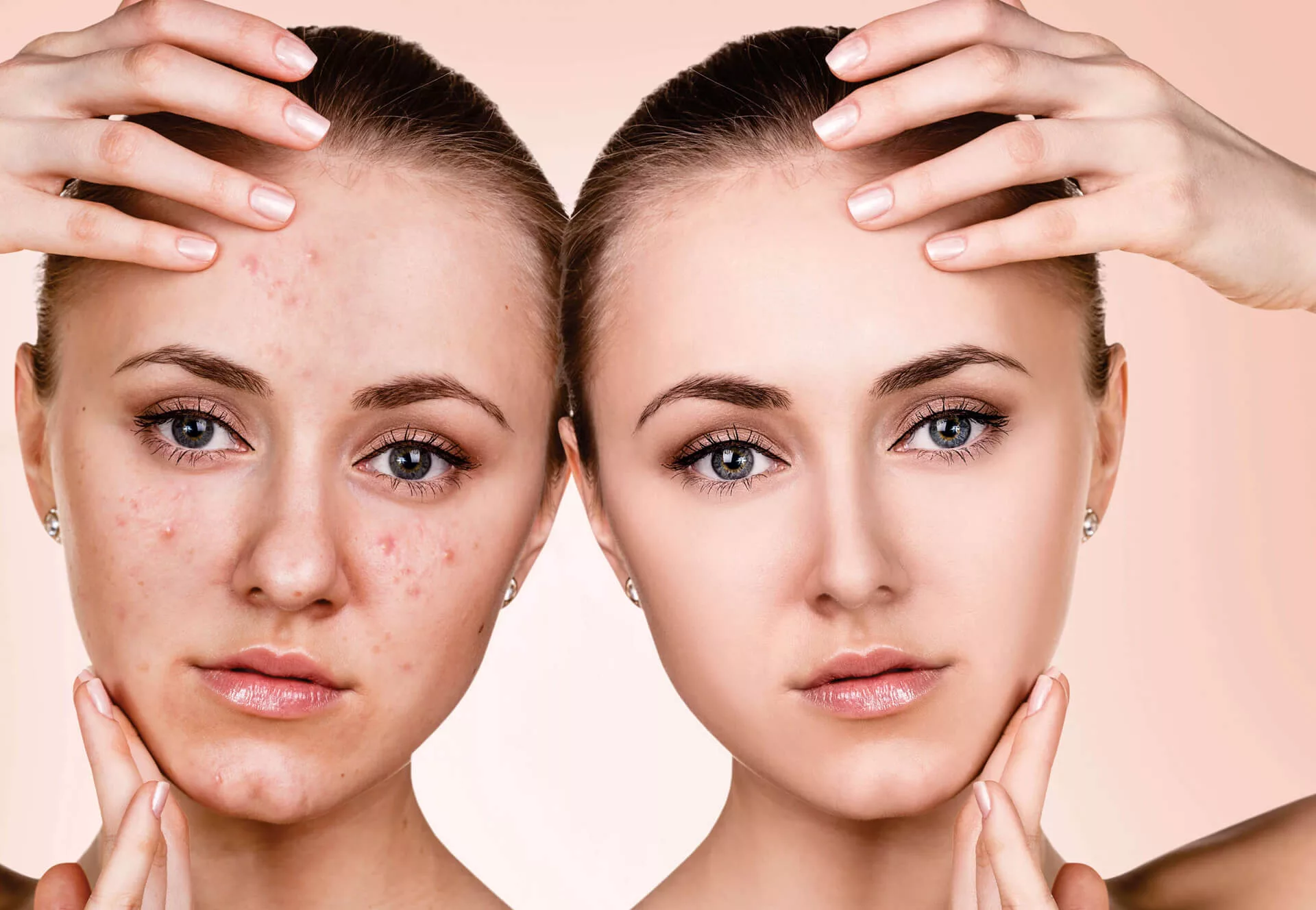 Acne Scars Causes Treatment In Hyderabad Acne Scars Causes Treatment In Hyderabad