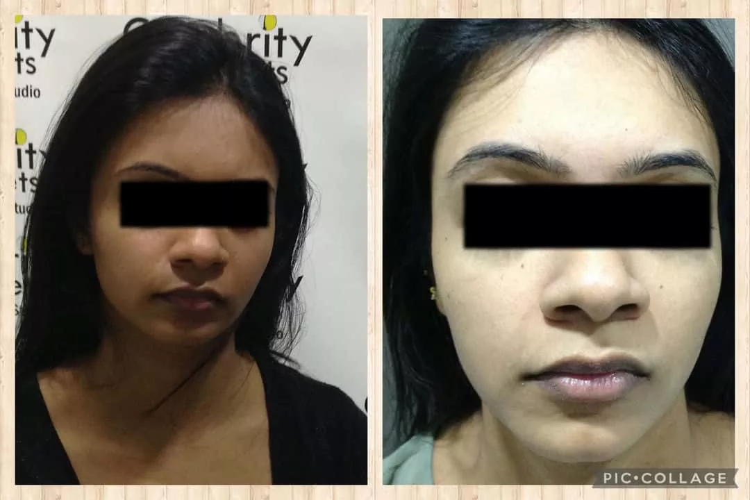 Skin Whitening Tretments Before And After Flash Sales Www Skin Whitening Tretments Before And After Flash Sales Www